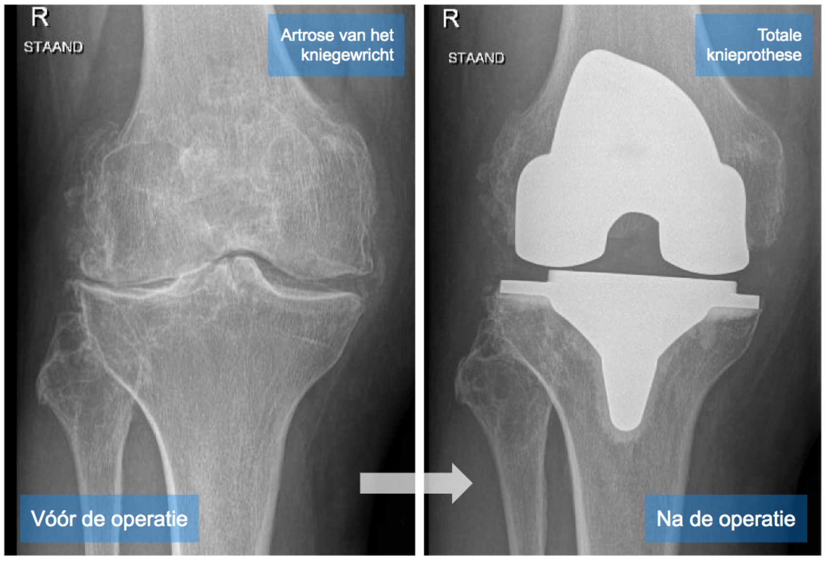 Artrose van de knie | Orthoclinic Brugge