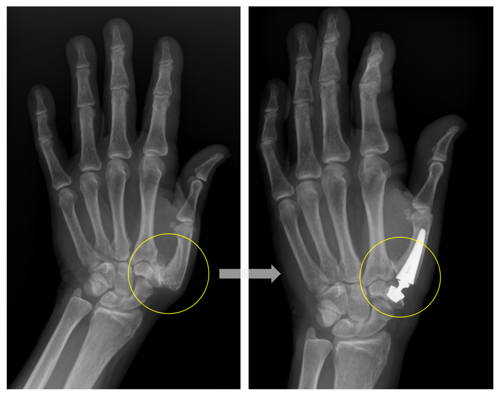 Duimbasisprothese | Orthoclinic - Orthopedie Brugge