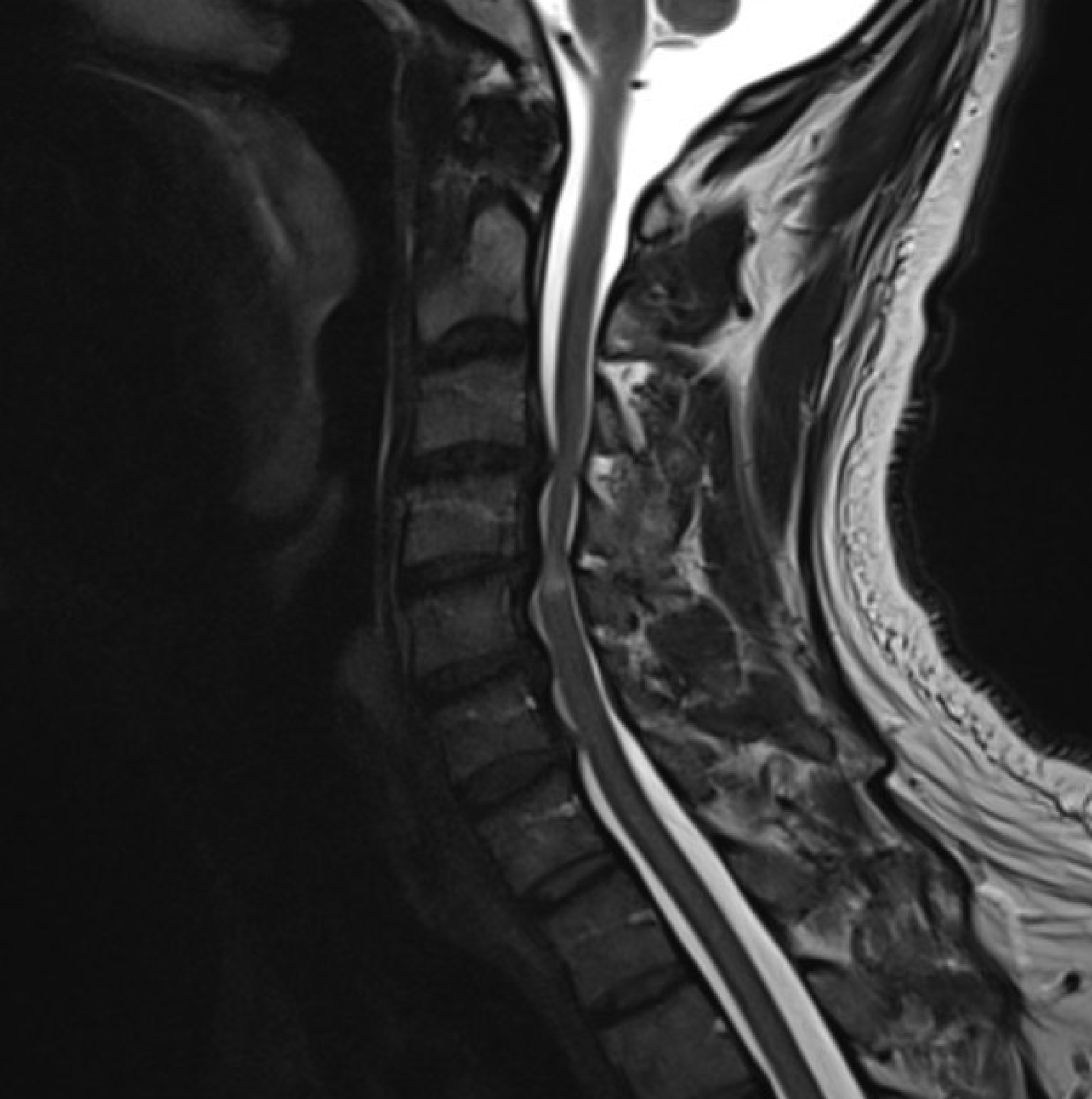 Cervicale spinaal kanaal stenose | Orthoclinic - Orthopedie Brugge
