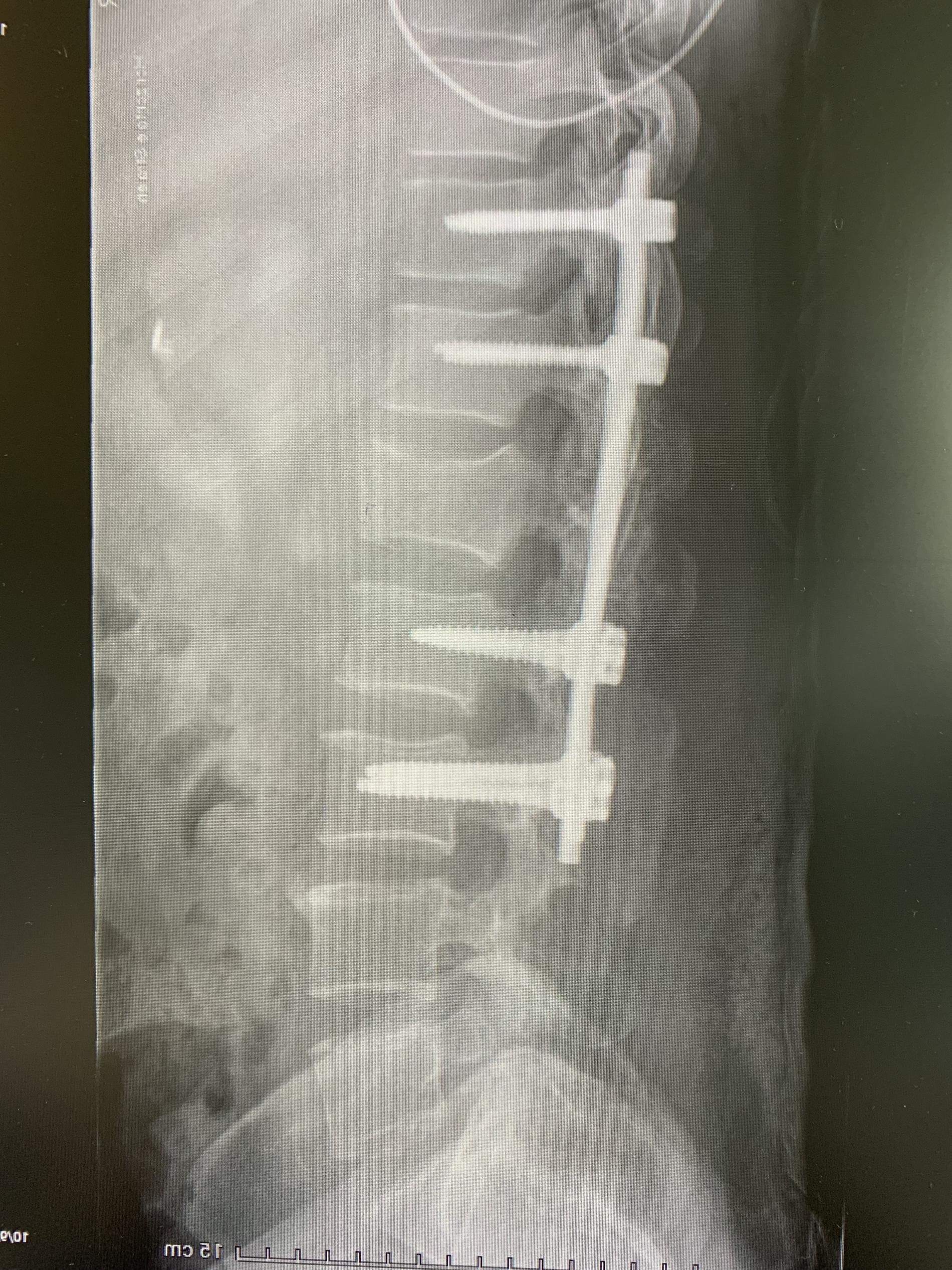 Osteoporotische fracturen van de wervelkolom | Orthoclinic Brugge
