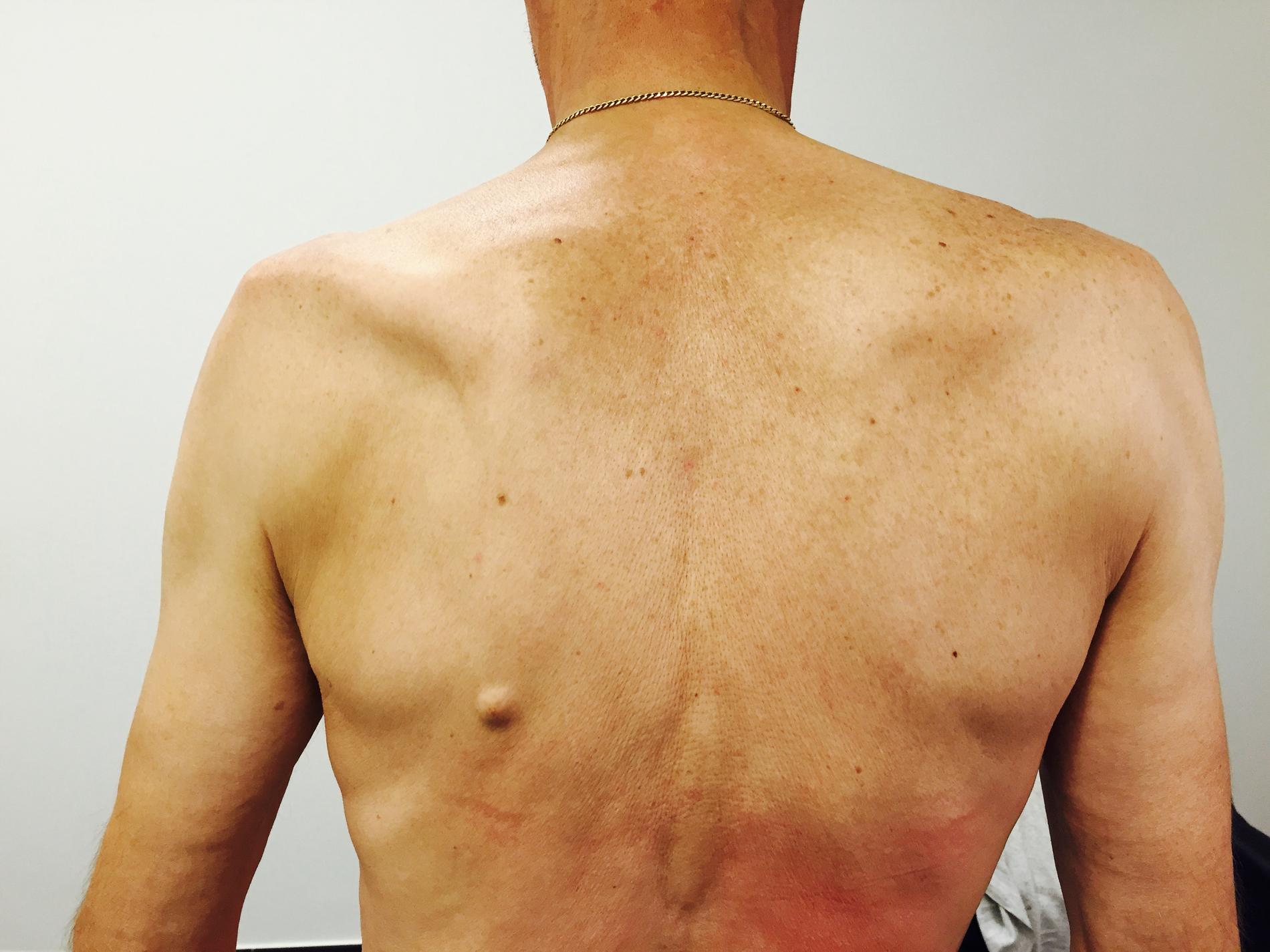 Rotator cuff scheur | Orthoclinic Brugge