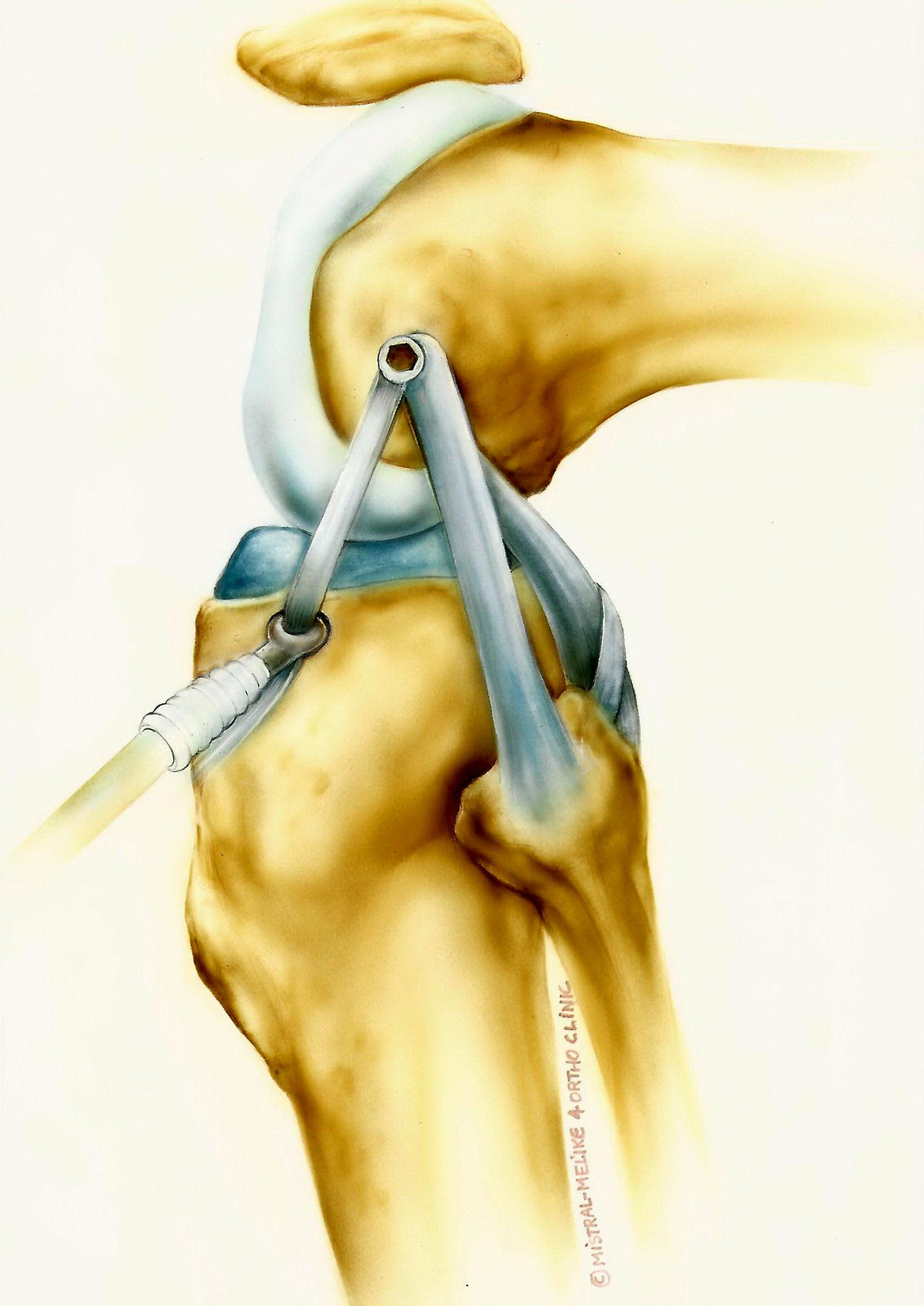 Voorste Kruisband ruptuur | Orthoclinic Brugge