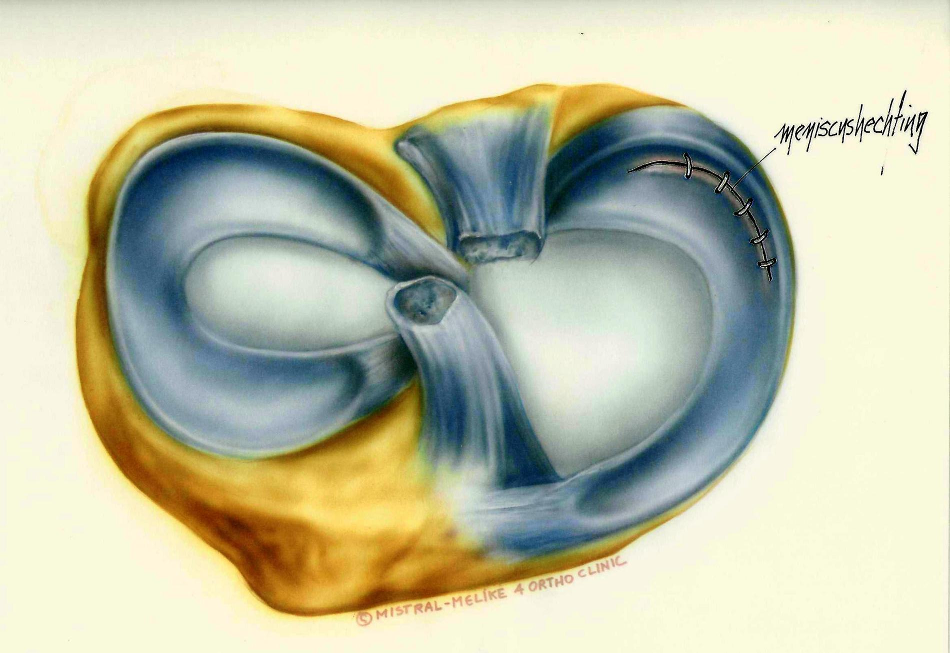 Meniscusscheur | Orthoclinic Brugge