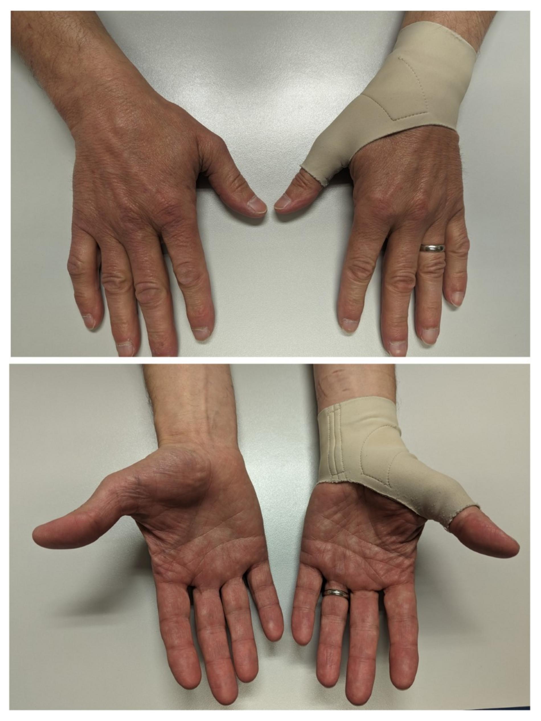 Duimbasis artrose | Orthoclinic Brugge