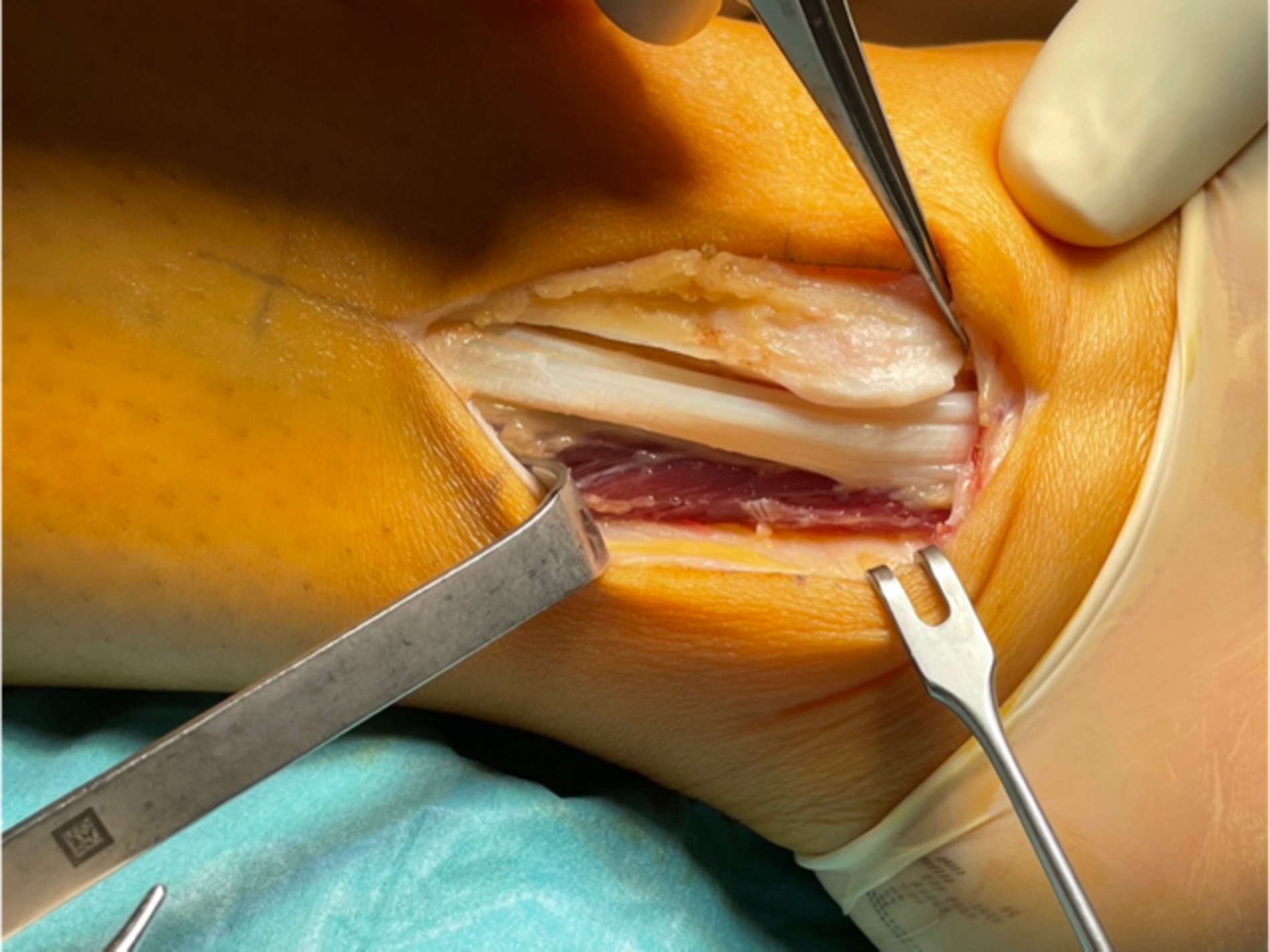 Peroneuspees letsel | Orthoclinic - Orthopedie Brugge