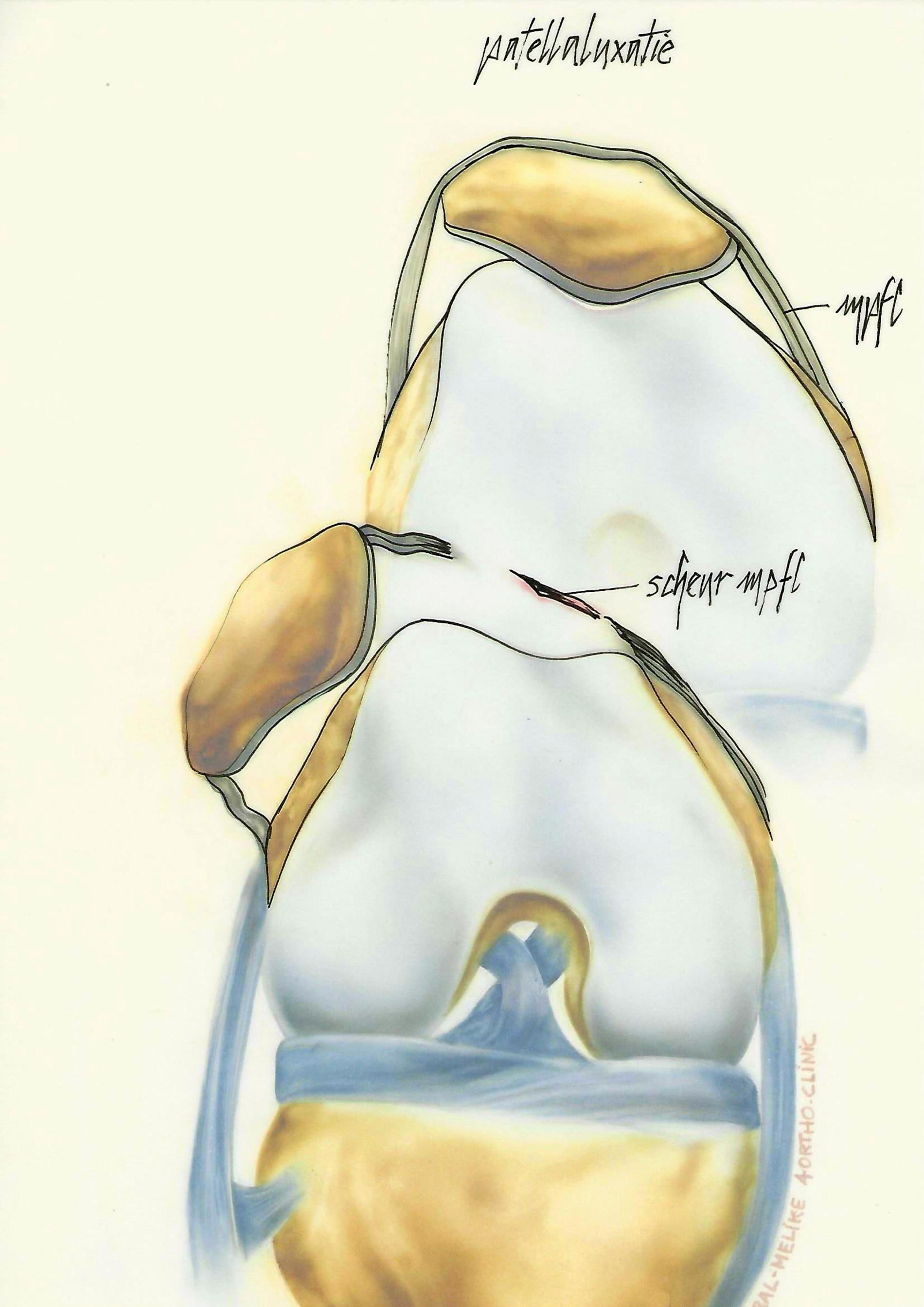 Patella luxatie | Orthoclinic Brugge