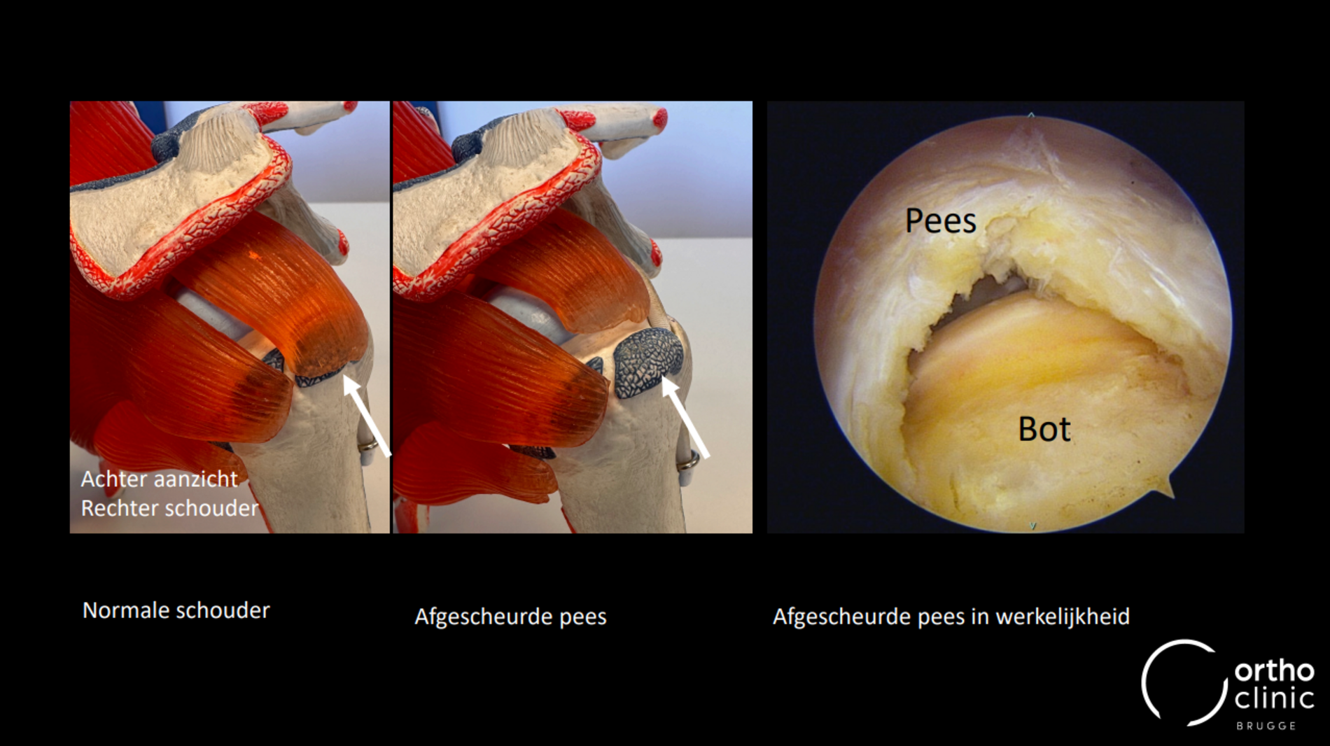 Rotator cuff scheur | Orthoclinic Brugge
