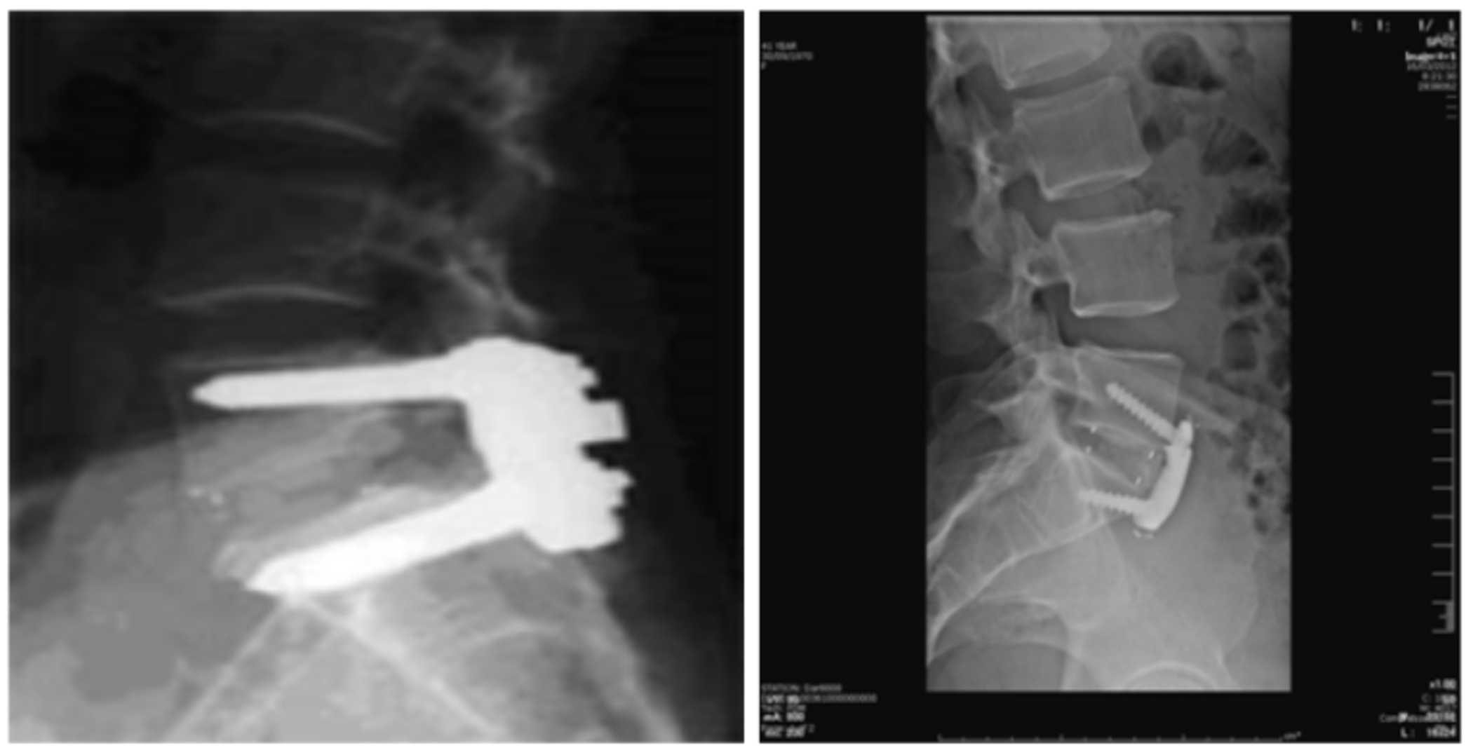Lumbale spinaal kanaal stenose | Orthoclinic - Orthopedie Brugge