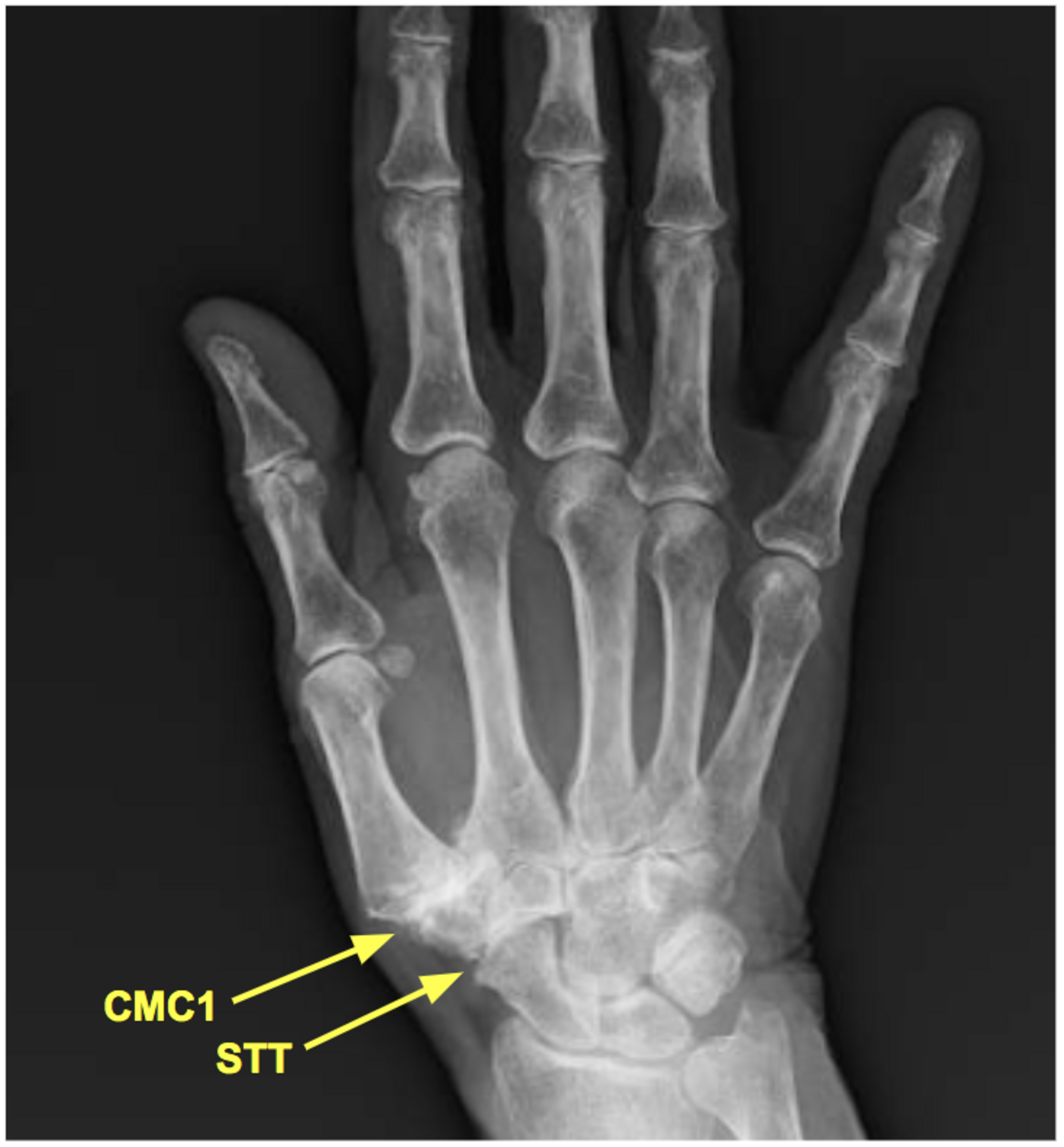 Duimbasis artrose | Orthoclinic Brugge