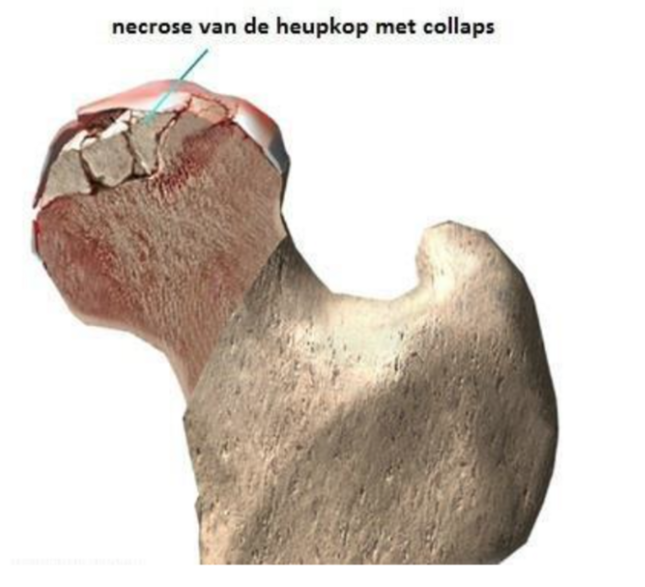 Avasculaire necrose heupkop | Orthoclinic - Orthopedie Brugge