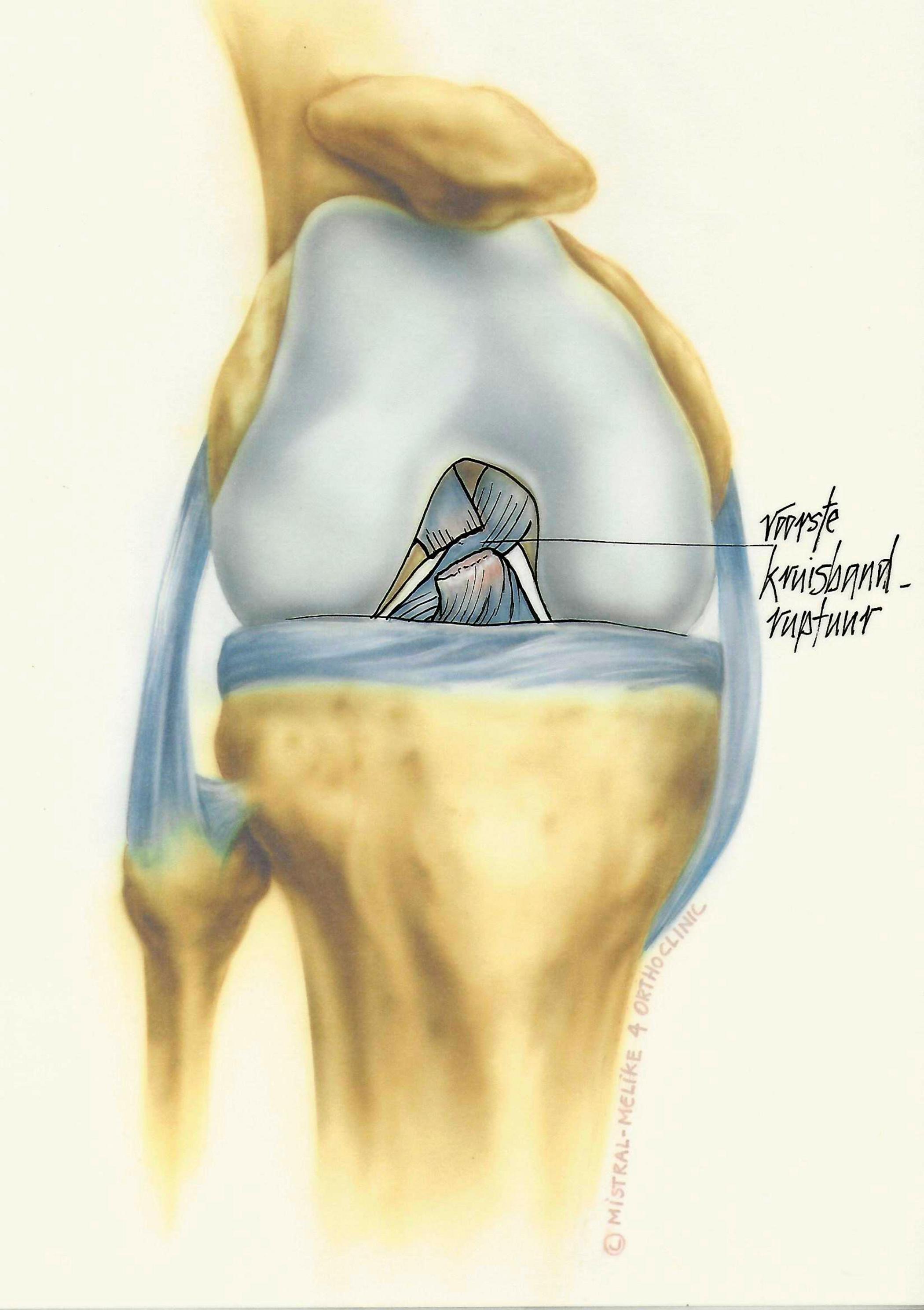 Voorste Kruisband ruptuur | Orthoclinic Brugge