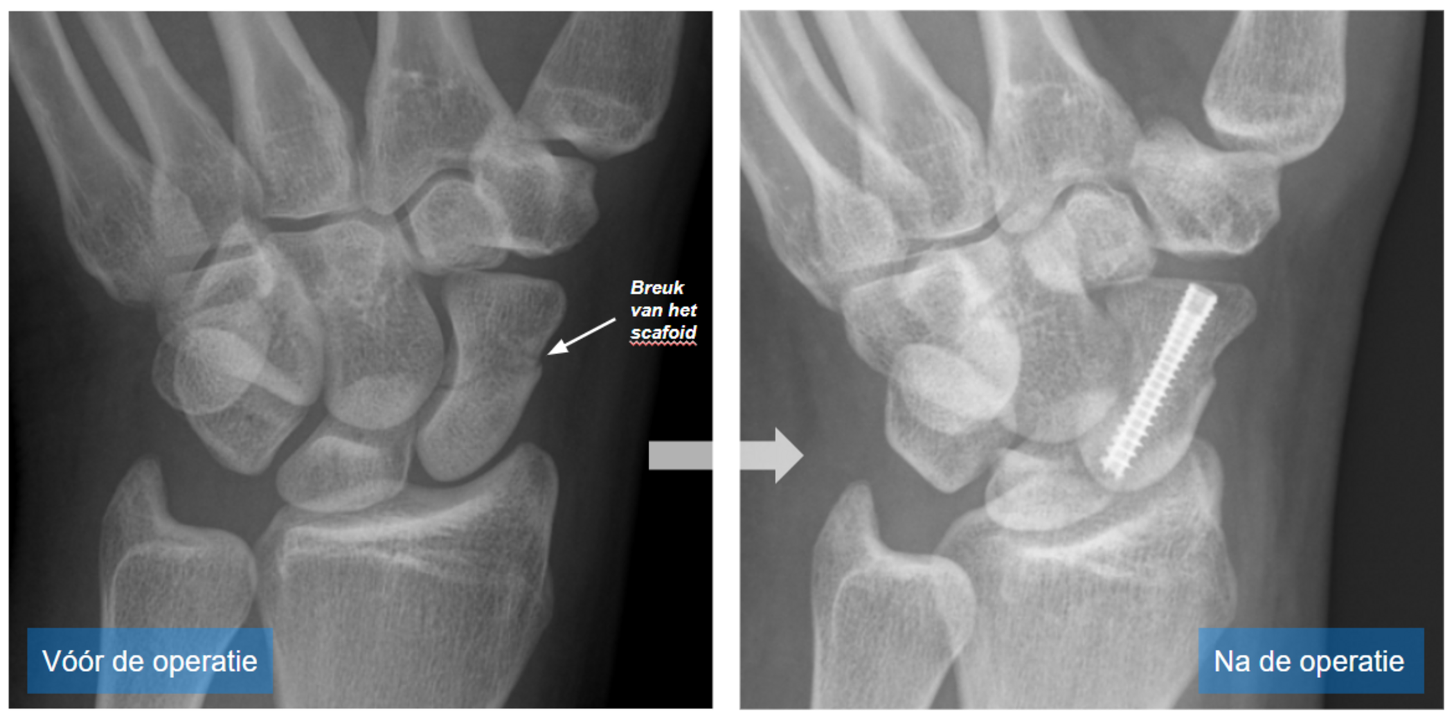 Scafoidfractuur | Orthoclinic Brugge