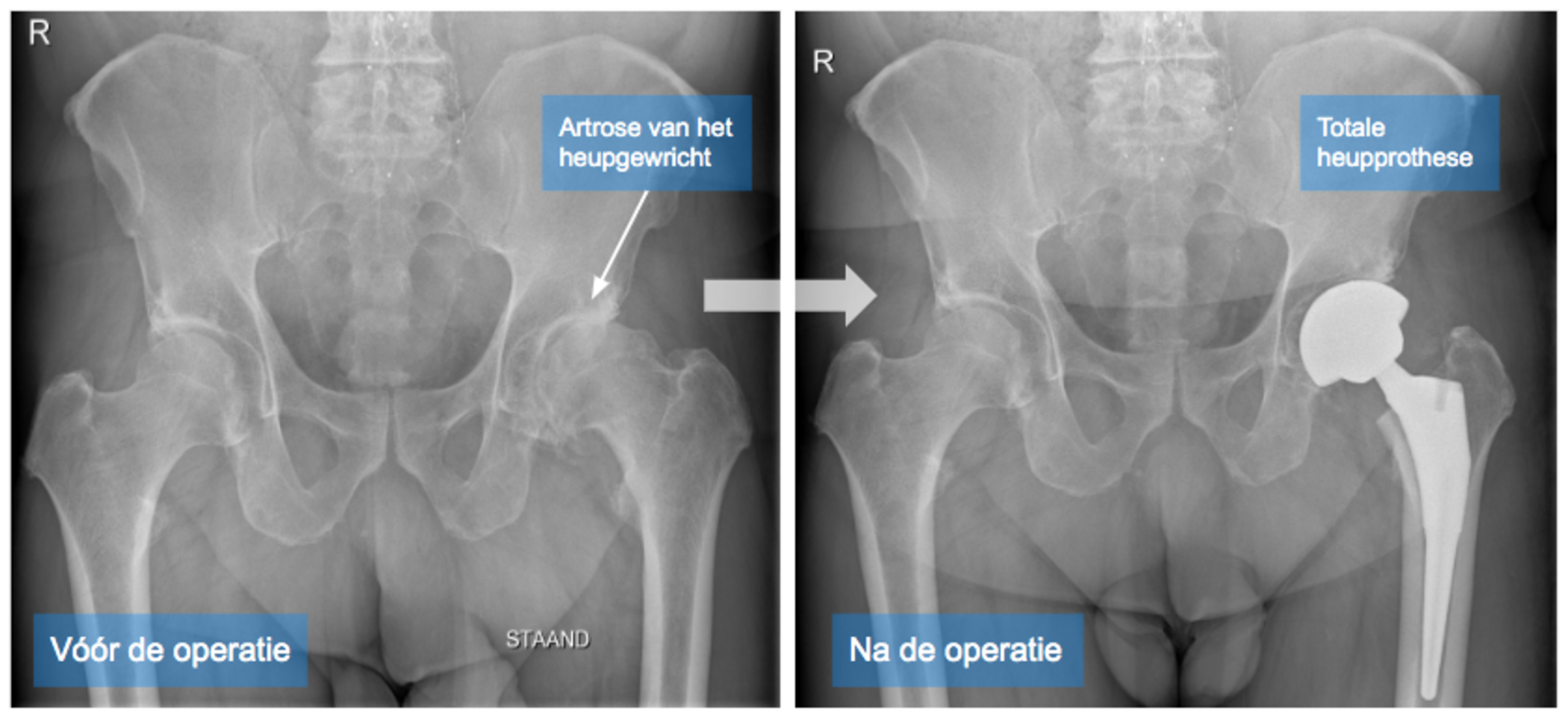 Coxartrose | Orthoclinic Brugge