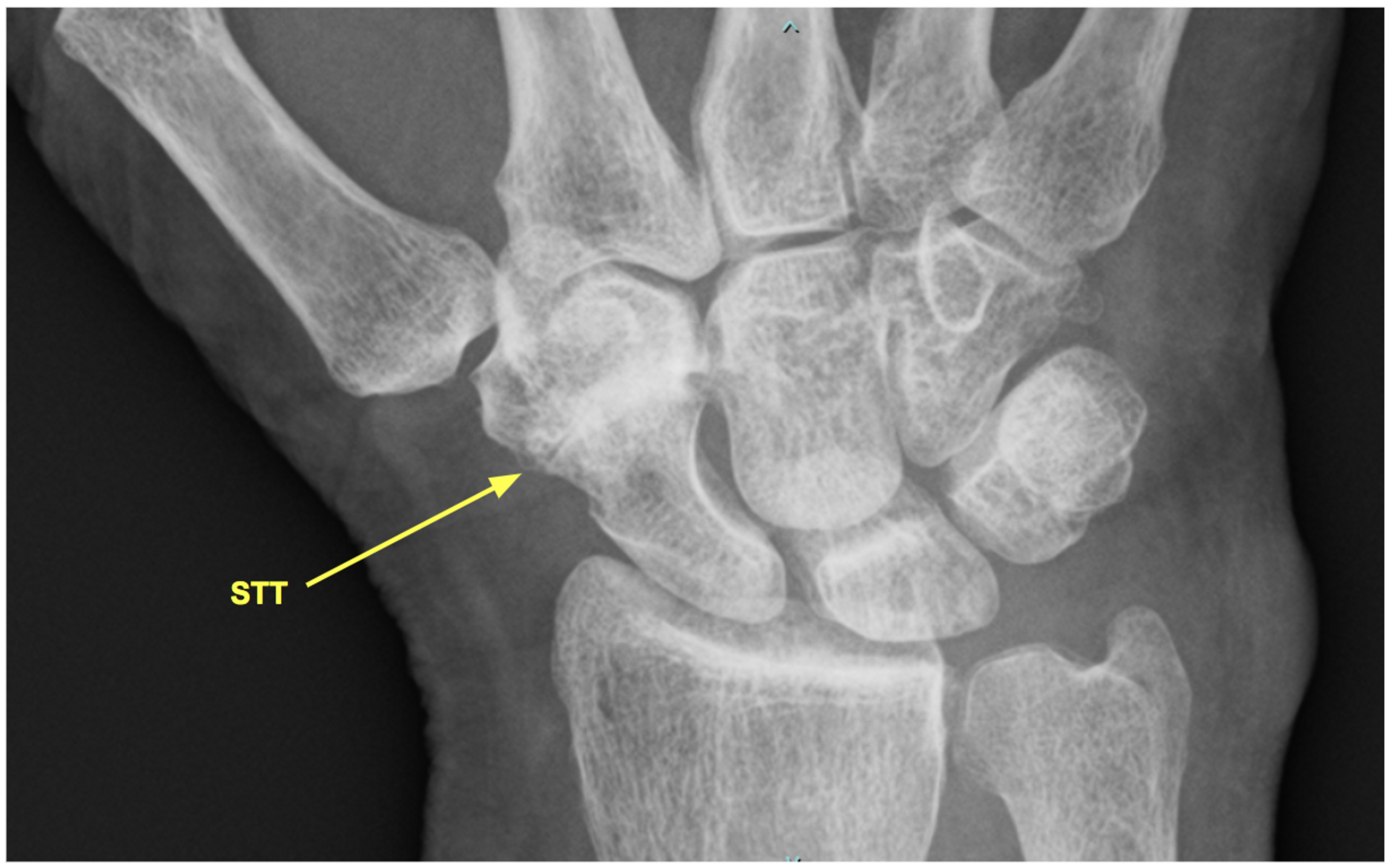 Duimbasis artrose | Orthoclinic Brugge