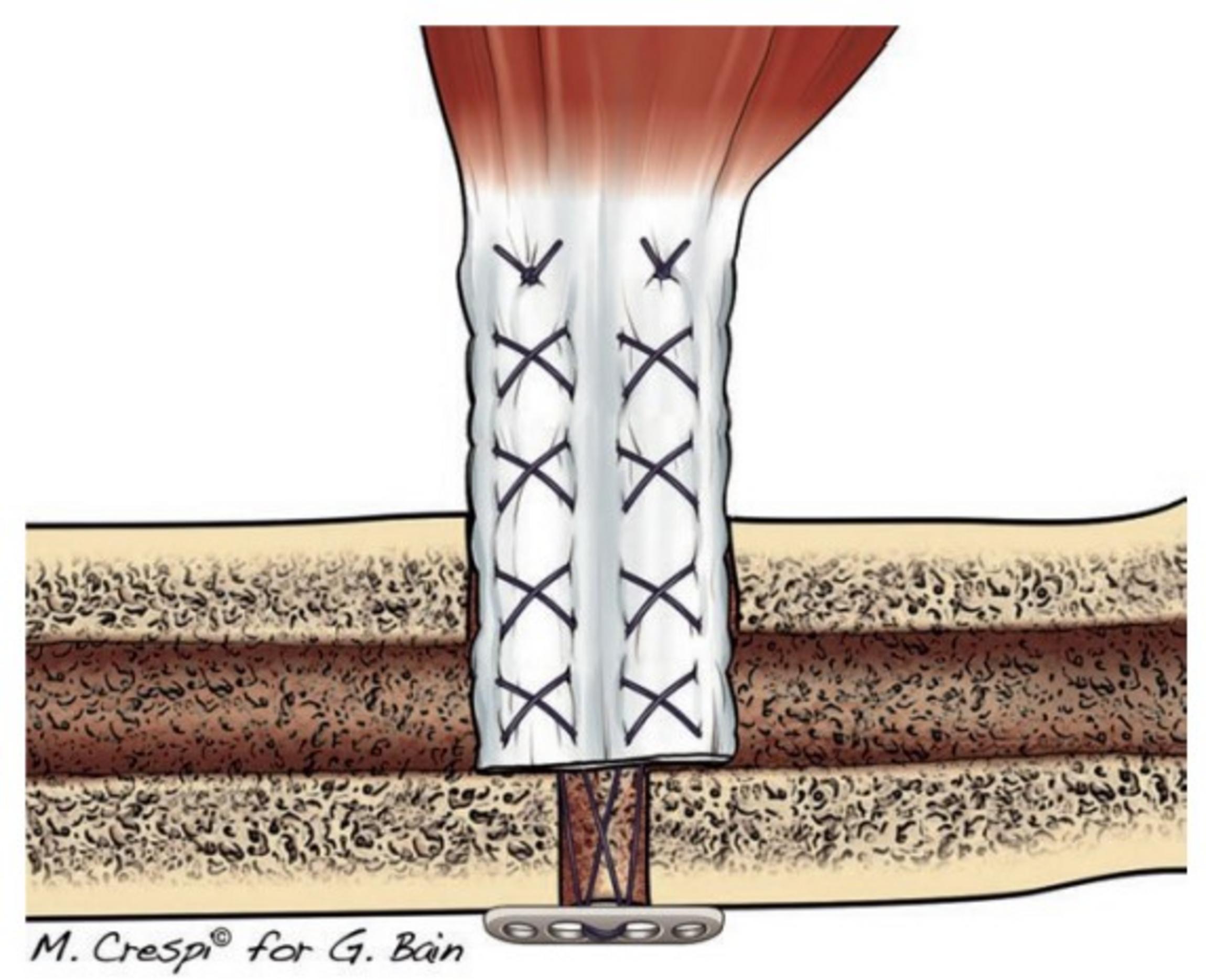 Bicepspees scheur | Orthoclinic Brugge