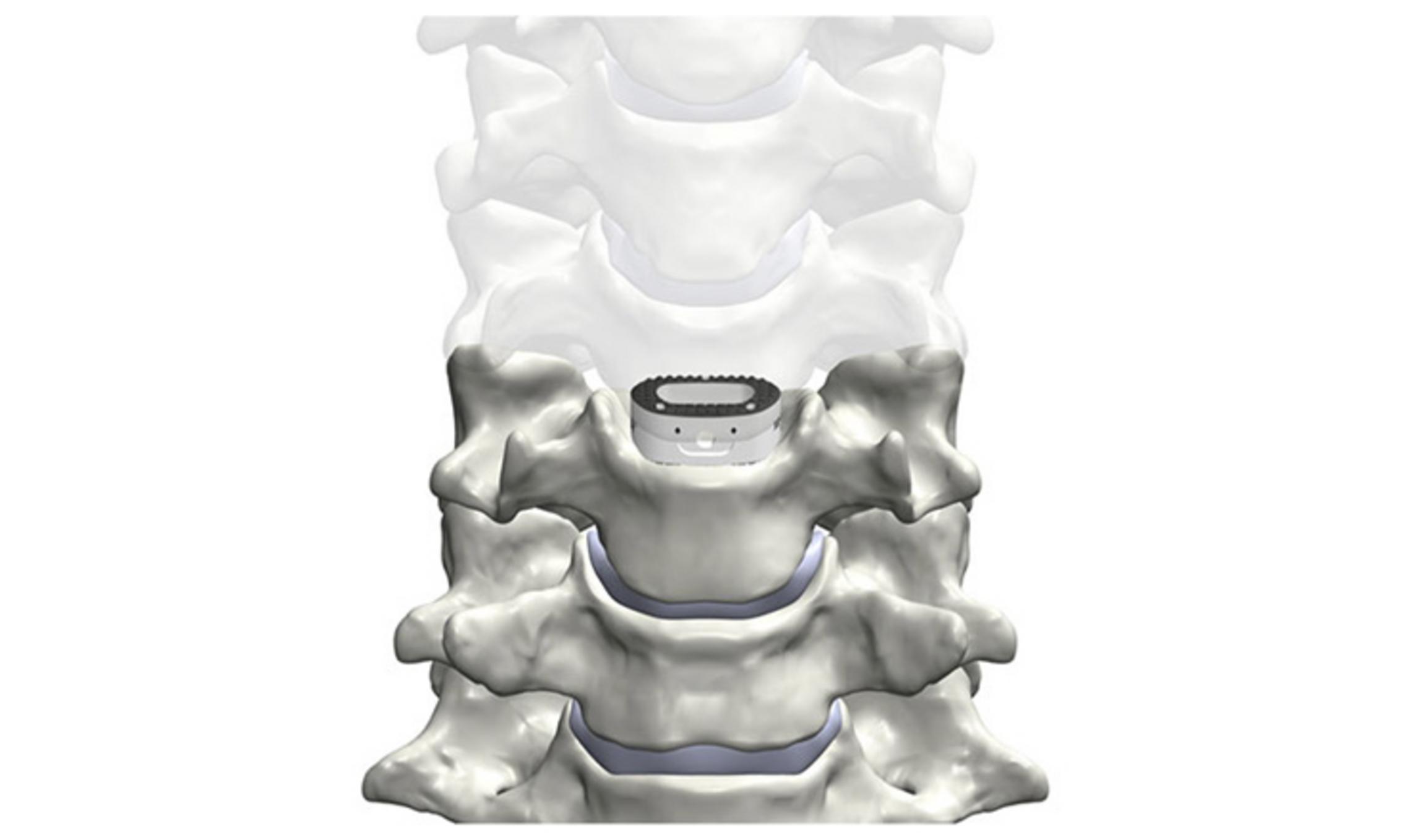Discus hernia (nek) | Orthoclinic Brugge
