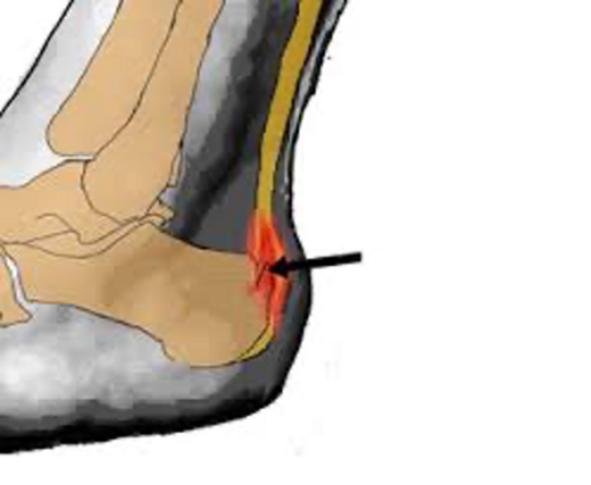 Achillespeesontsteking | Orthoclinic - Orthopedie Brugge