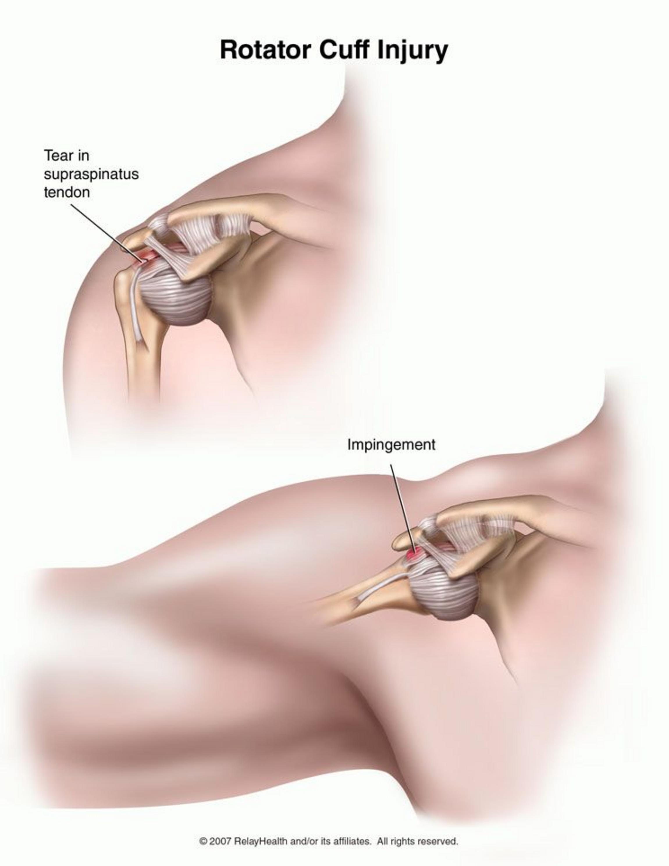 Rotator cuff scheur | Orthoclinic Brugge Rotator cuff scheur | Orthoclinic Brugge