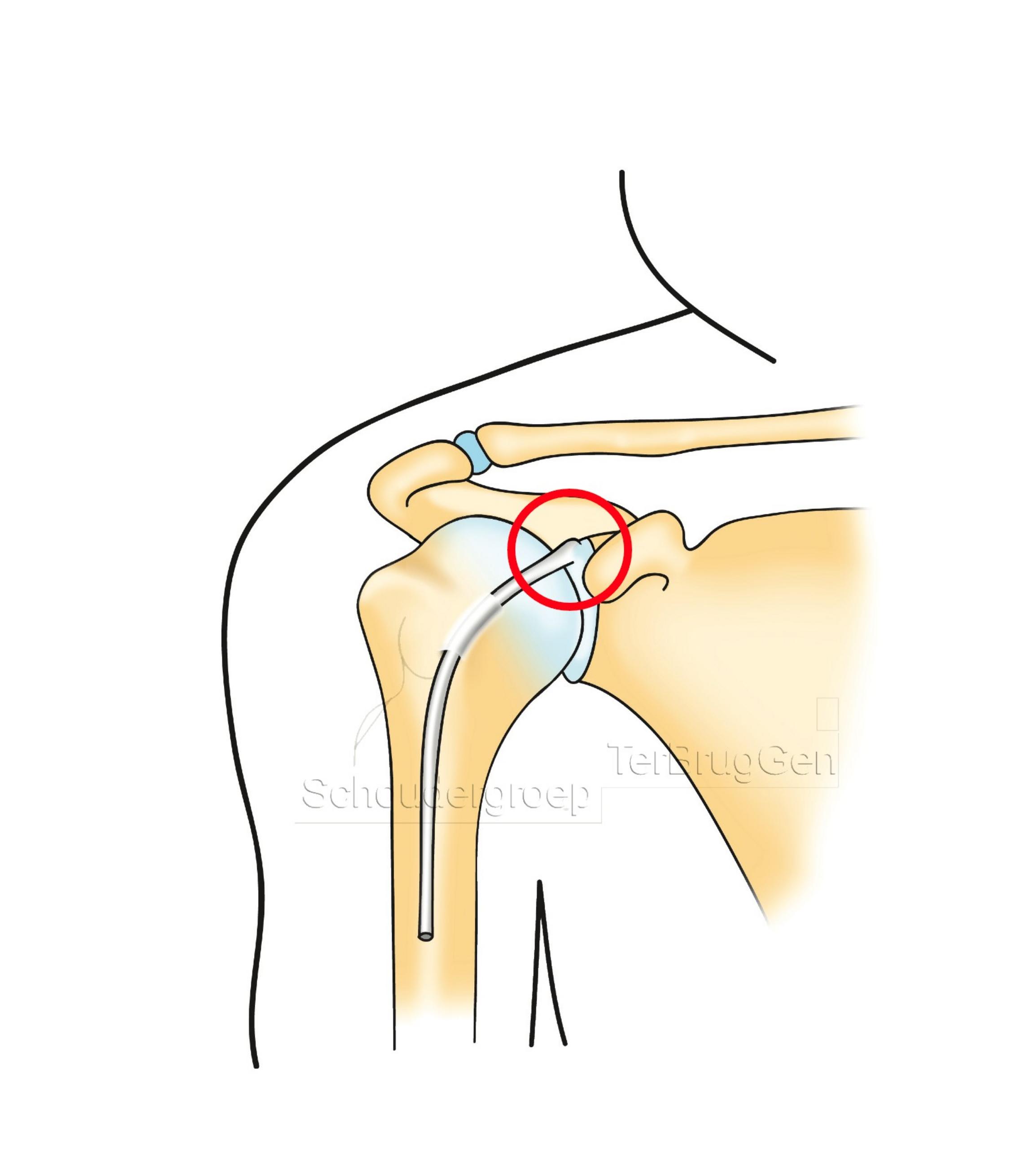 Letsels van de lange bicepspees | Orthoclinic - Orthopedie Brugge