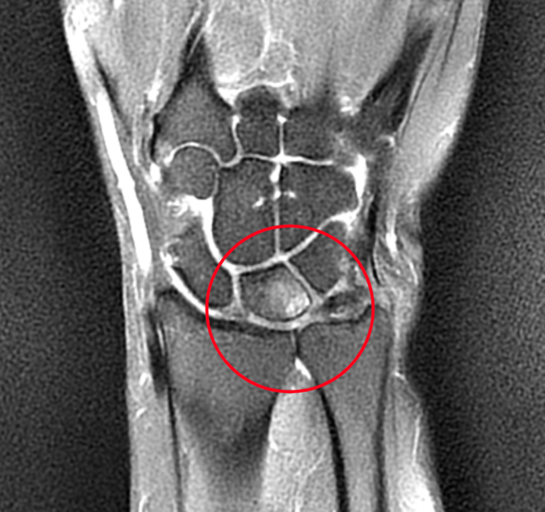 Ulnair impactie syndroom | Orthoclinic - Orthopedie Brugge