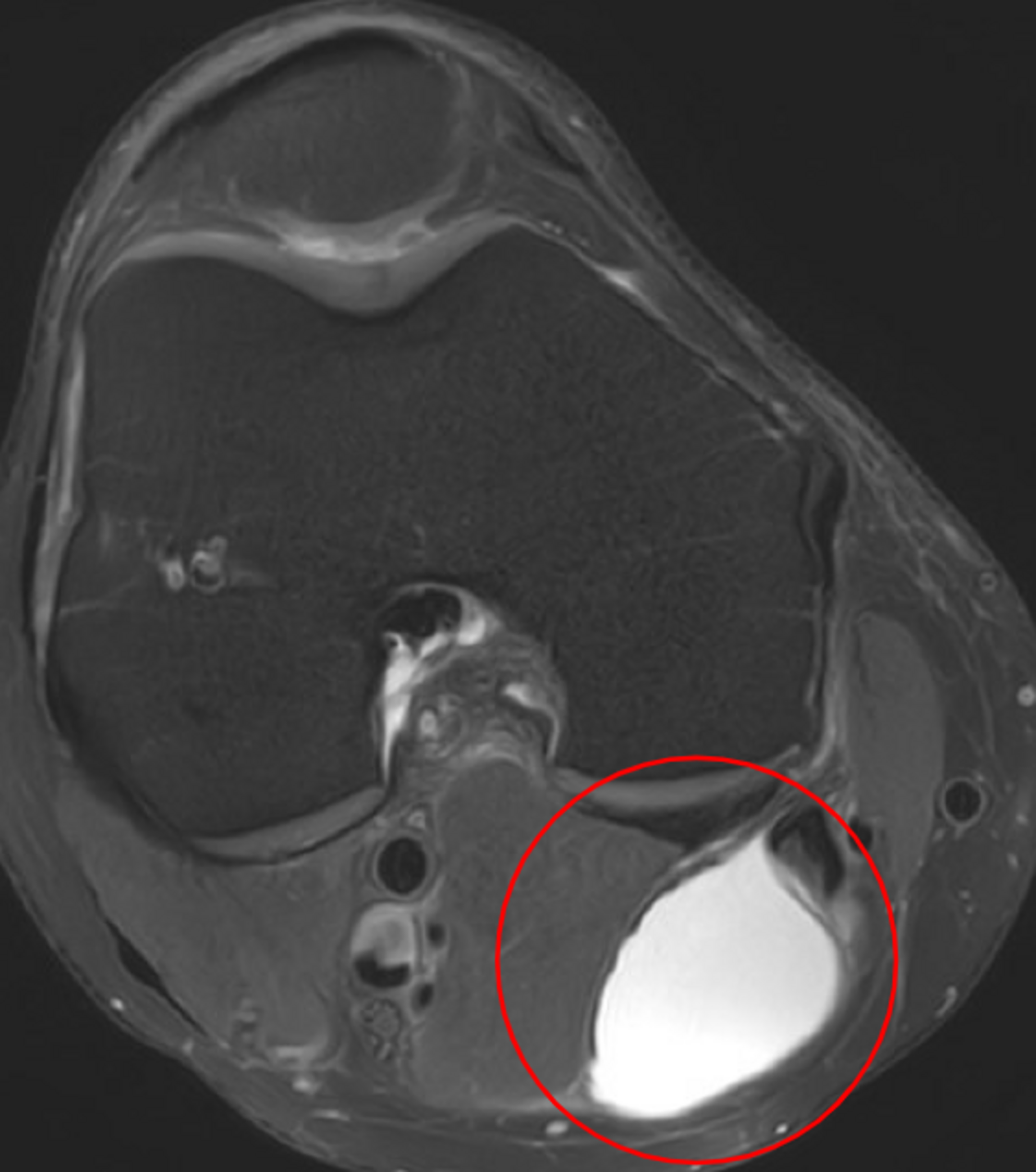 Baker cyste | Orthoclinic Brugge