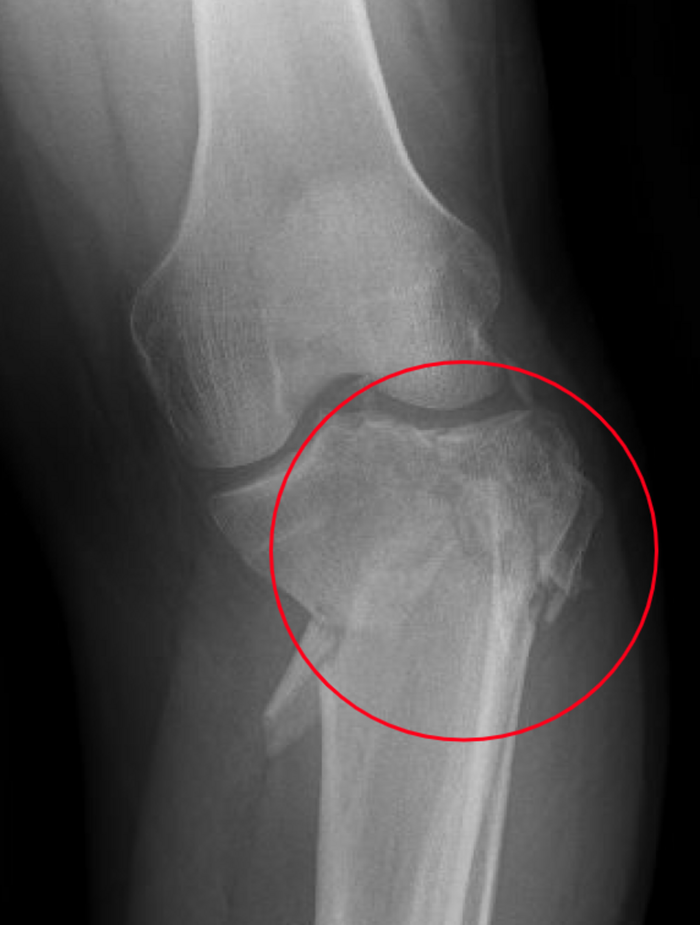 Fracturen rond de knie | Orthoclinic Brugge