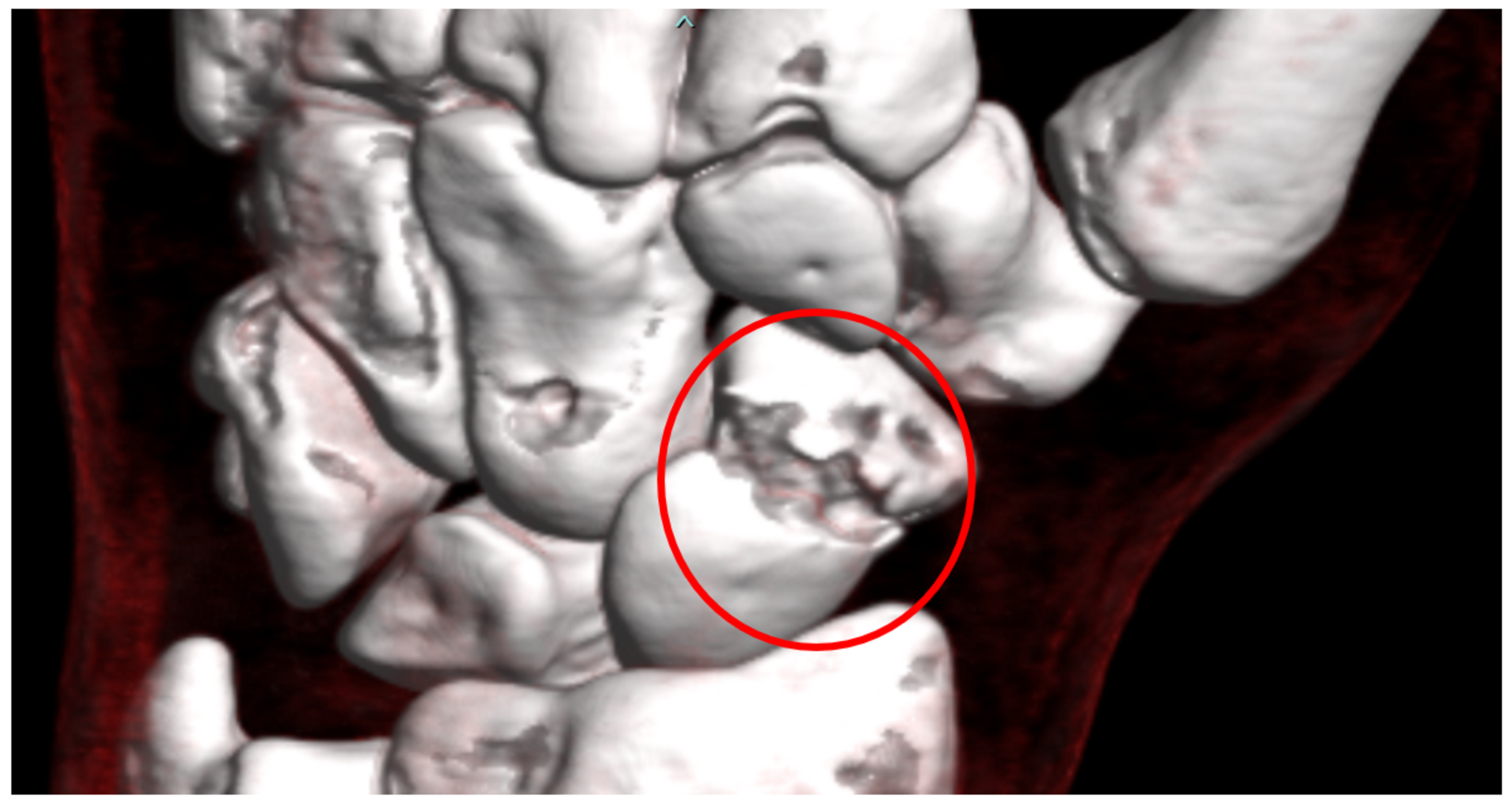 Scafoidfractuur | Orthoclinic Brugge