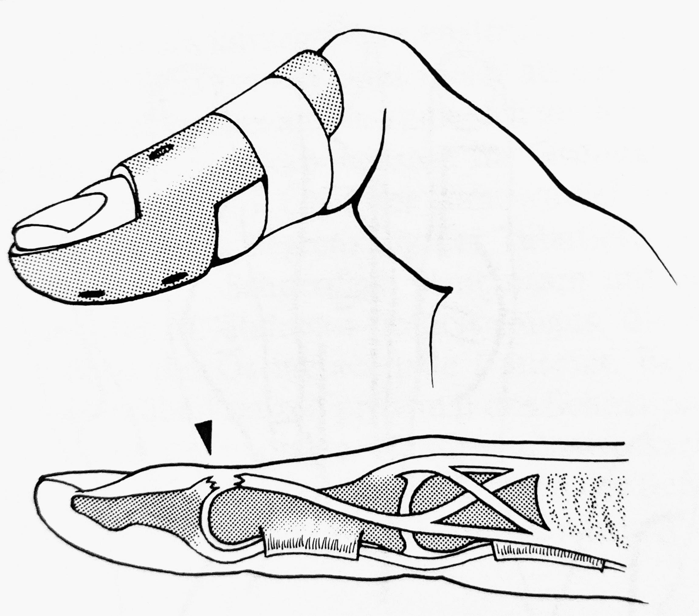 Mallet vinger | Orthoclinic - Orthopedie Brugge