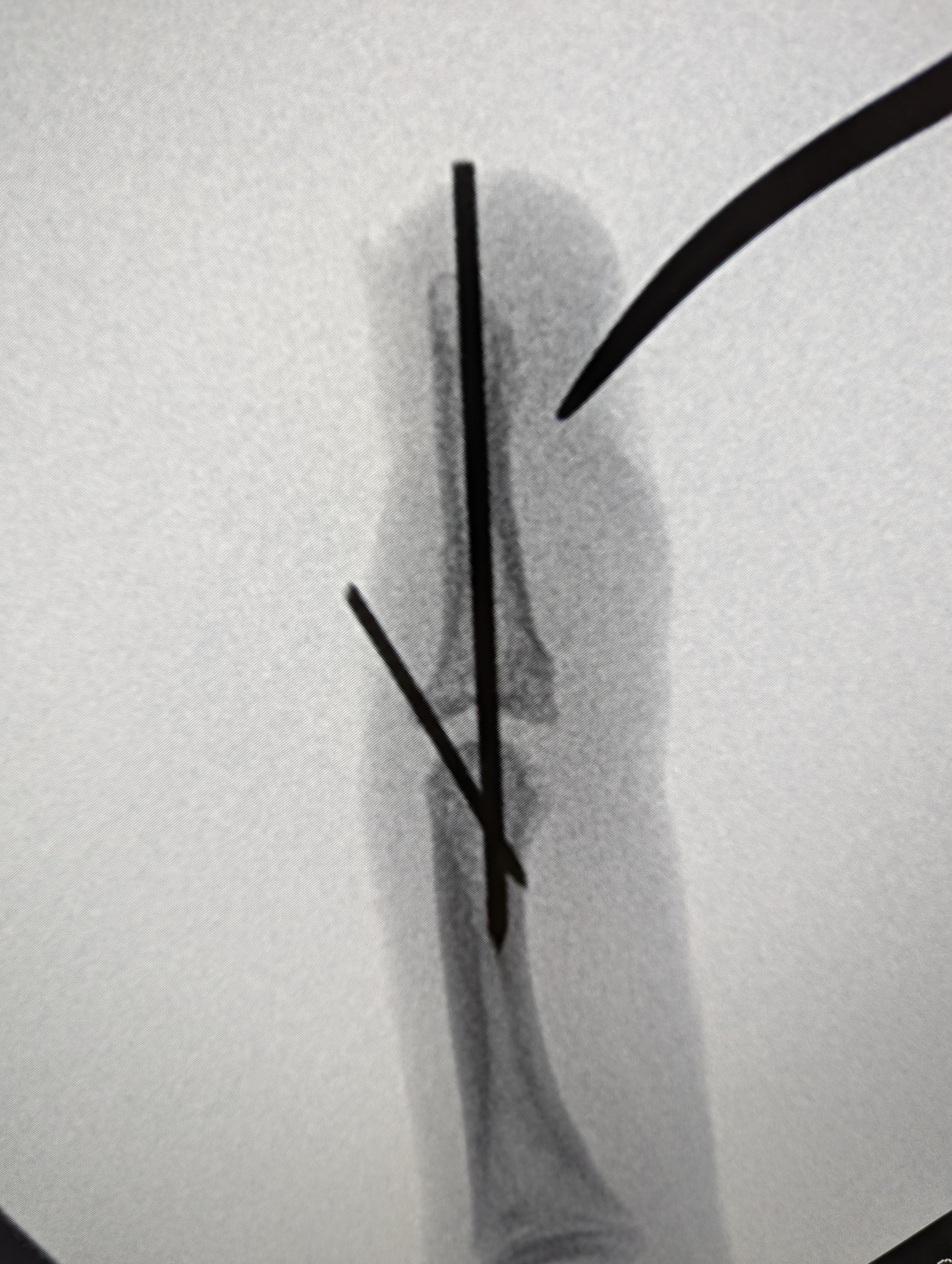 Mallet vinger | Orthoclinic - Orthopedie Brugge