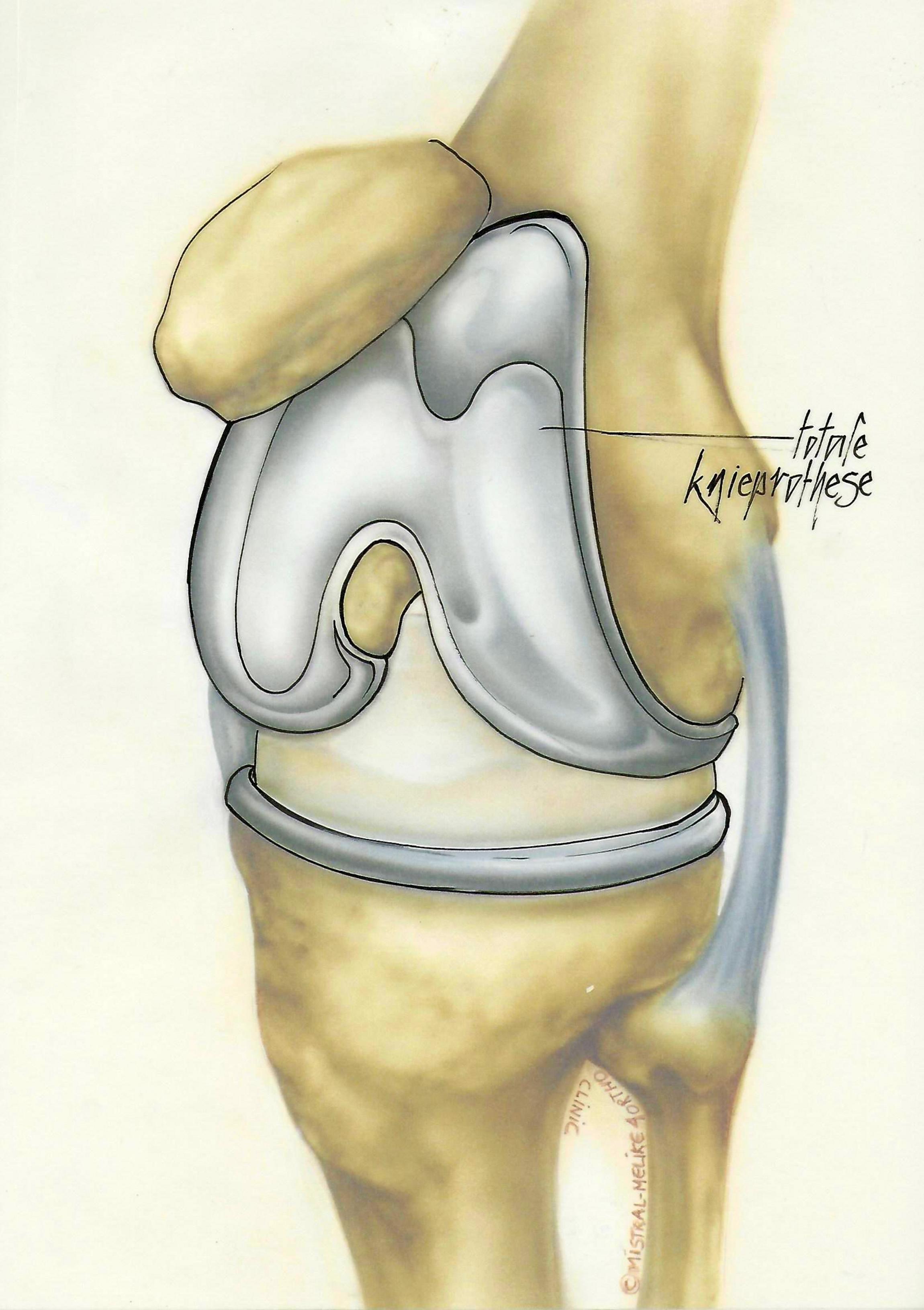 Artrose van de knie | Orthoclinic Brugge