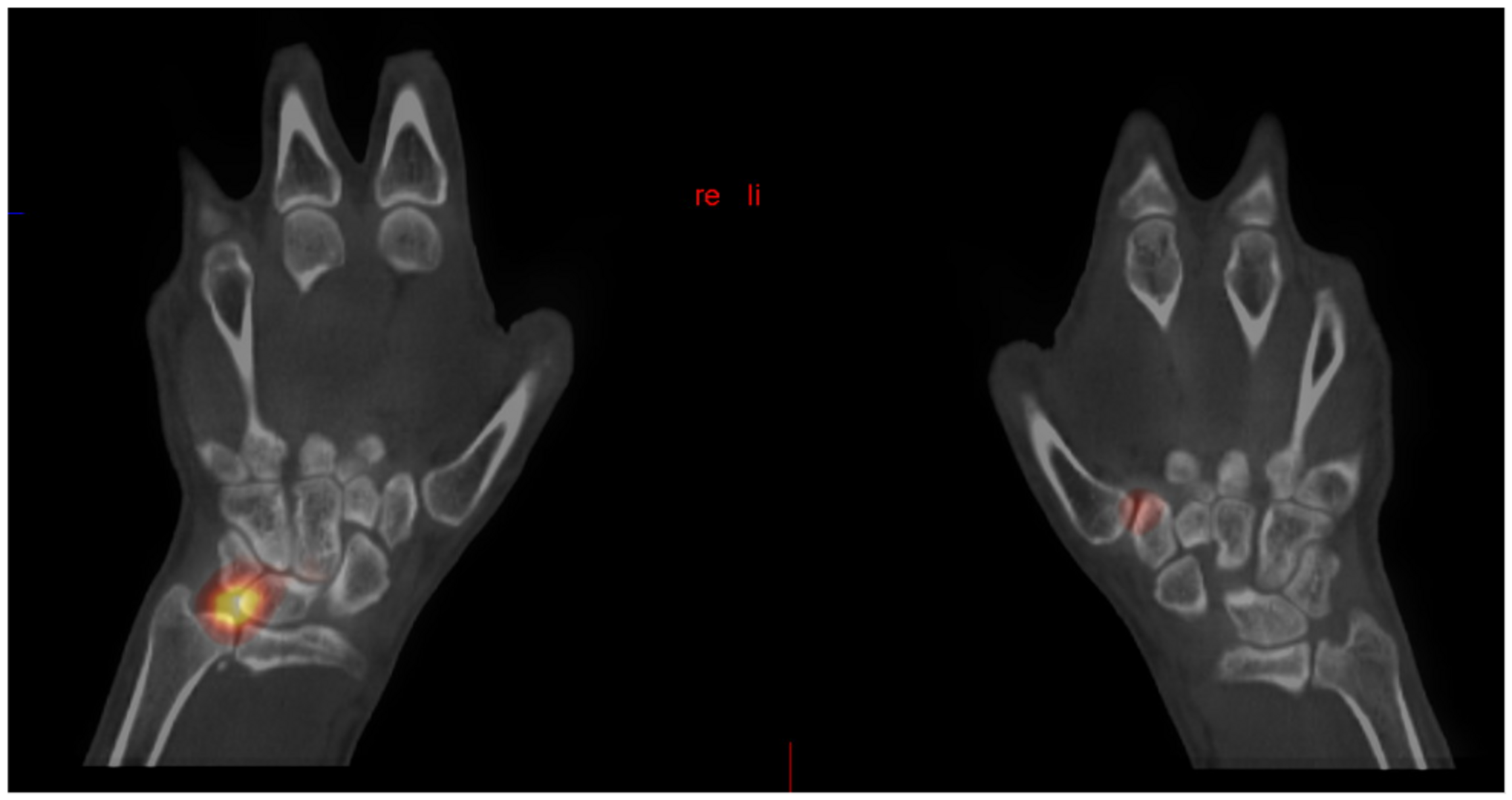 Ulnair impactie syndroom | Orthoclinic - Orthopedie Brugge