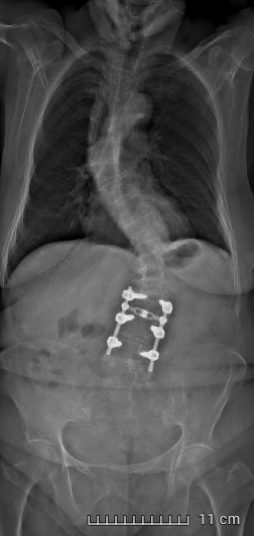 Scoliose bij volwassenen | Orthoclinic - Orthopedie Brugge