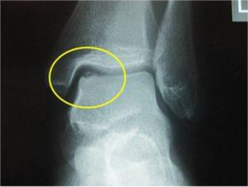 Kraakbeenletsel enkelgewricht | Orthoclinic - Orthopedie Brugge