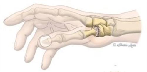 Duimbasis artrose | Orthoclinic Brugge