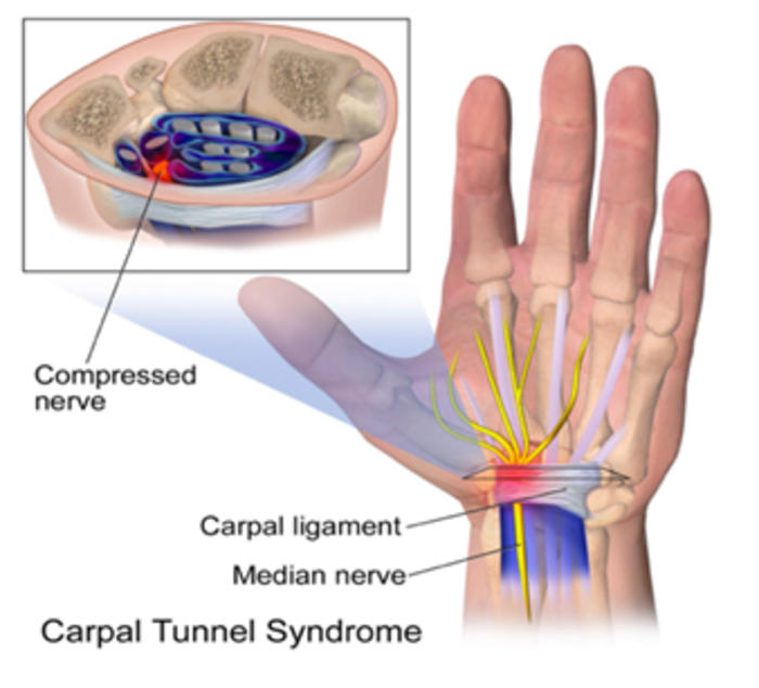 Carpaal tunnel syndroom | Orthoclinic Brugge
