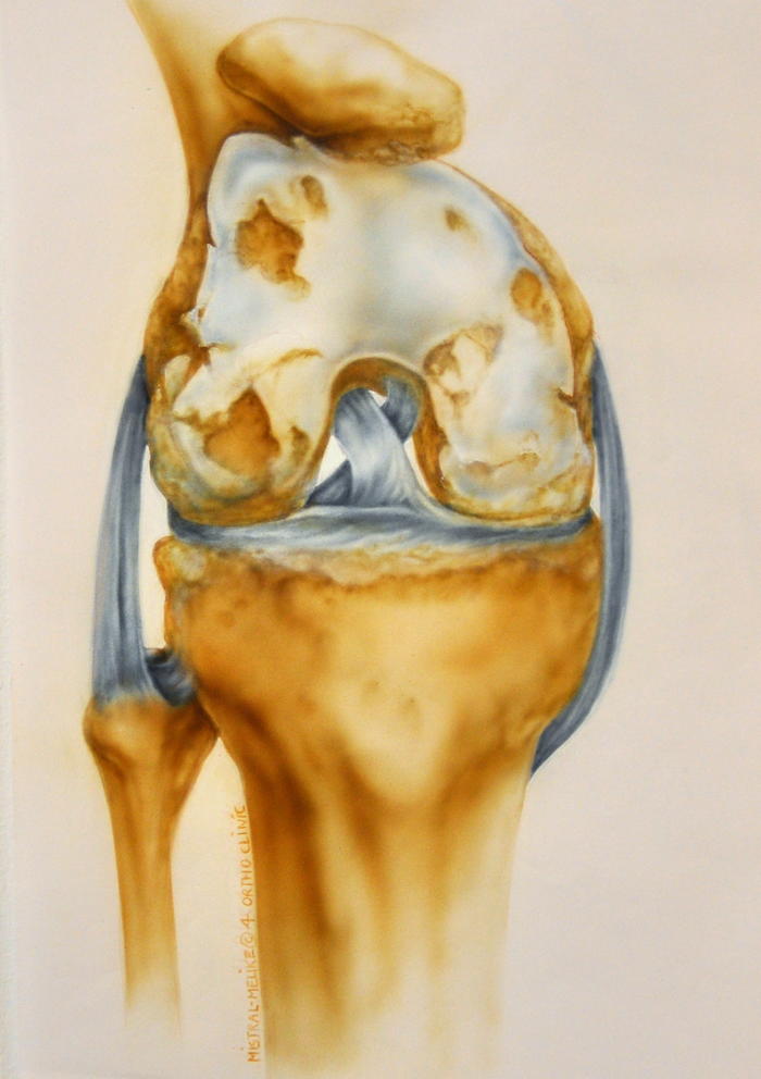 Artrose van de knie | Orthoclinic Brugge