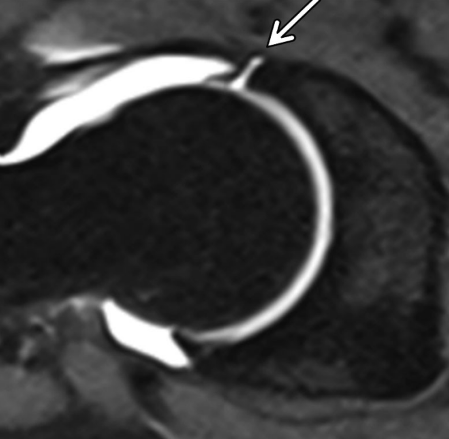 Labrumscheur | Orthoclinic - Orthopedie Brugge