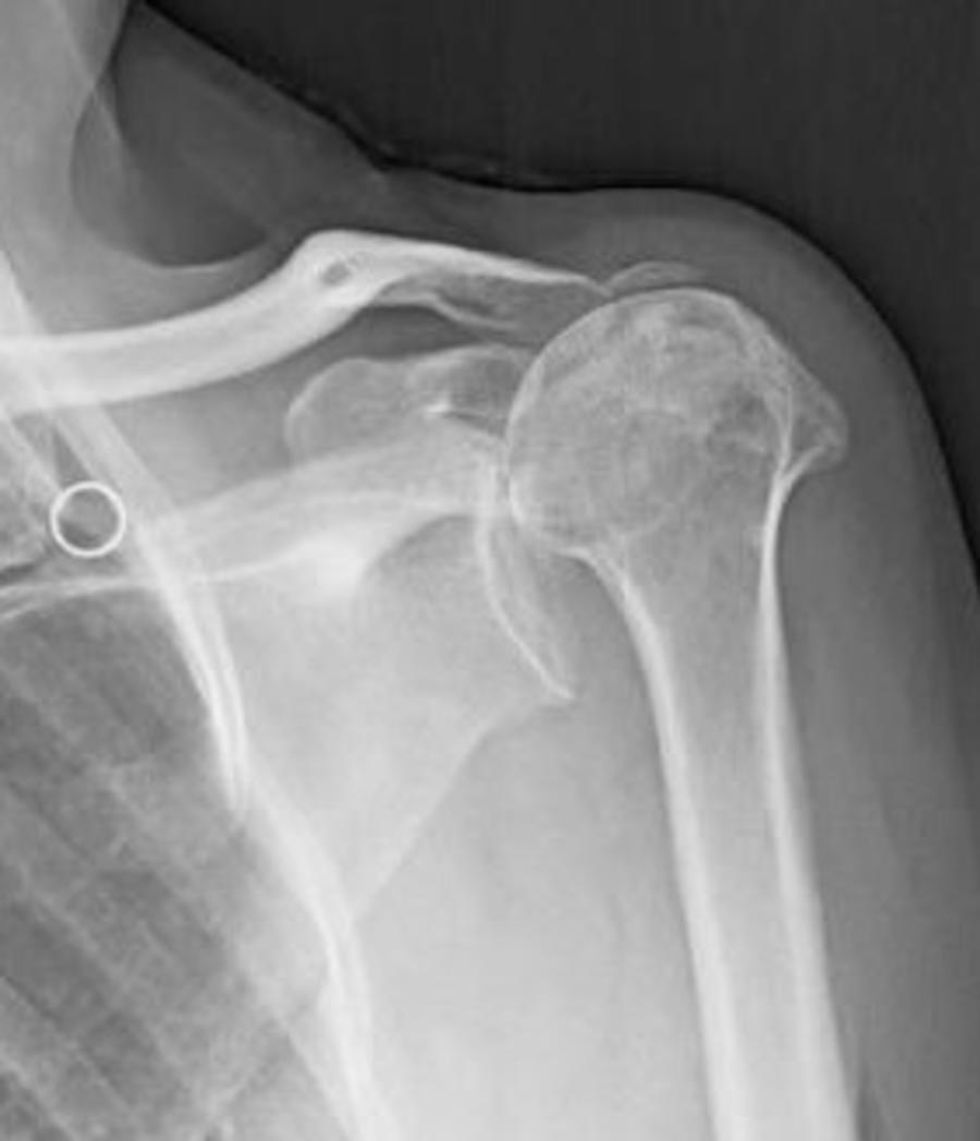 Rotator cuff scheur | Orthoclinic Brugge