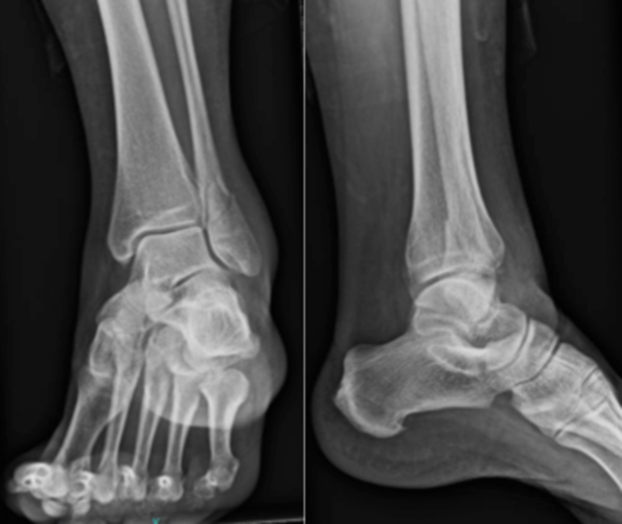 Herstel enkelbreuk | Orthoclinic Brugge