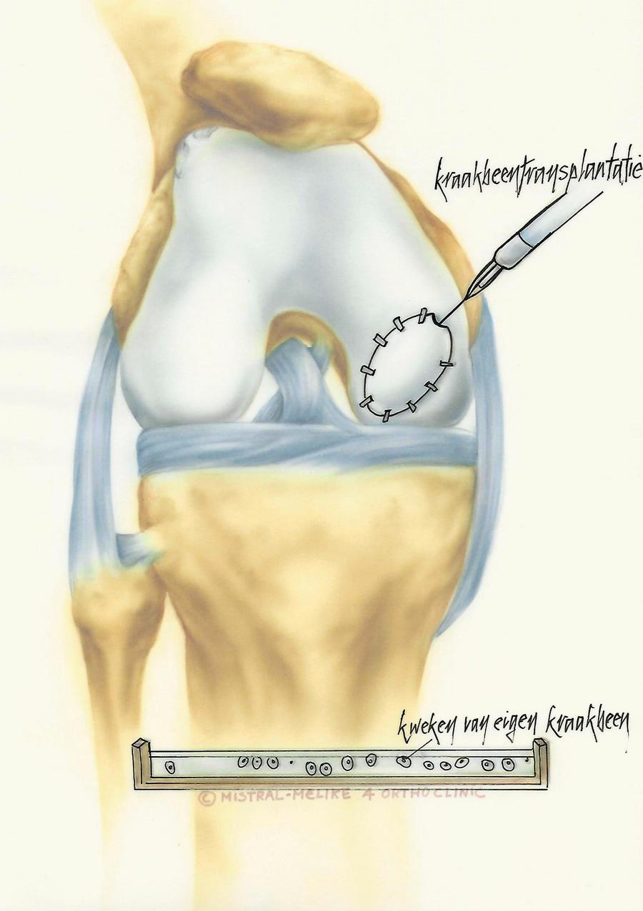Kraakbeenletsels in het kniegewricht | Orthoclinic Brugge